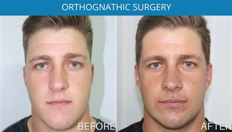 Jaw Removal