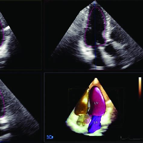 A Fully Automated Lv Endocardial Contour Tracing Using The 3d Download Scientific Diagram