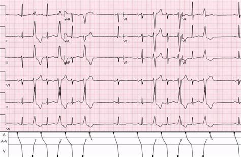 Concealed Conduction Alchetron The Free Social Encyclopedia