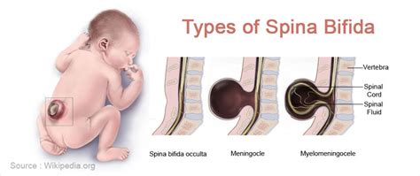 Neural Tube Defects Types Causes Diagnosis And Treatment
