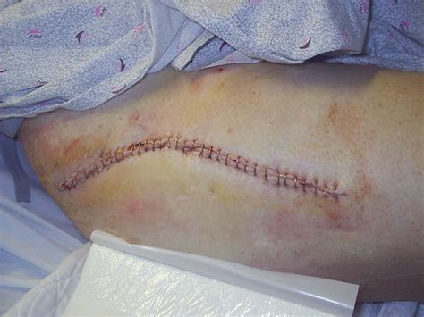 Defective Implants Critical Signs And Symptoms