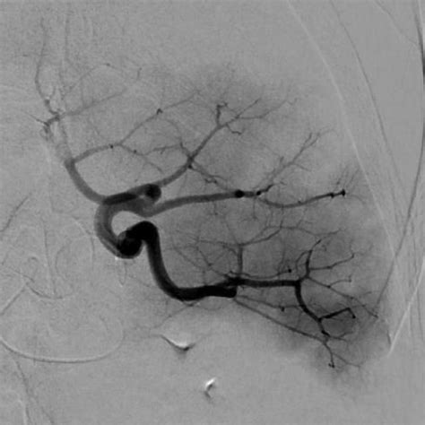 Post Operative Subtracted Splenic Angiogram Showing Post Embolization Download Scientific