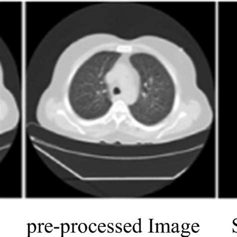 input image output image after pre processing and nodule segmented