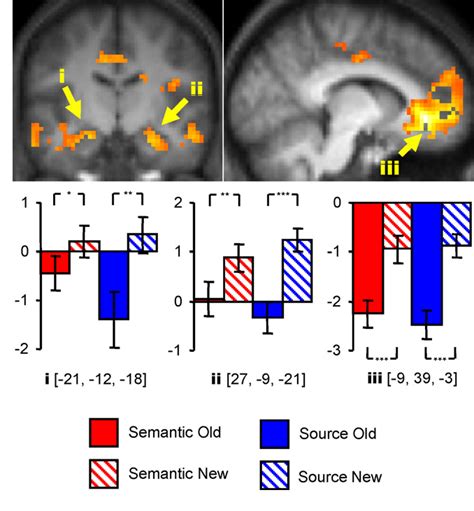Table 1 From Right Dorsolateral Prefrontal Cortex Is Engaged During Post Retrieval Processing Of