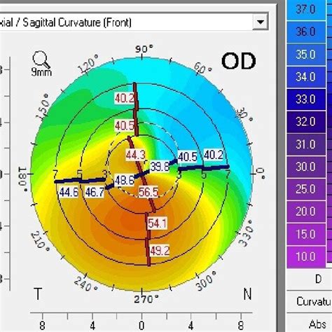Corneal Topography Demonstrating Regular Astigmatism Download Scientific Diagram