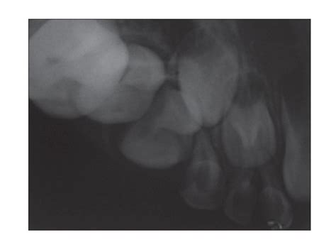 Anomalies In Primary Dentition Their Distribution And Correlation With