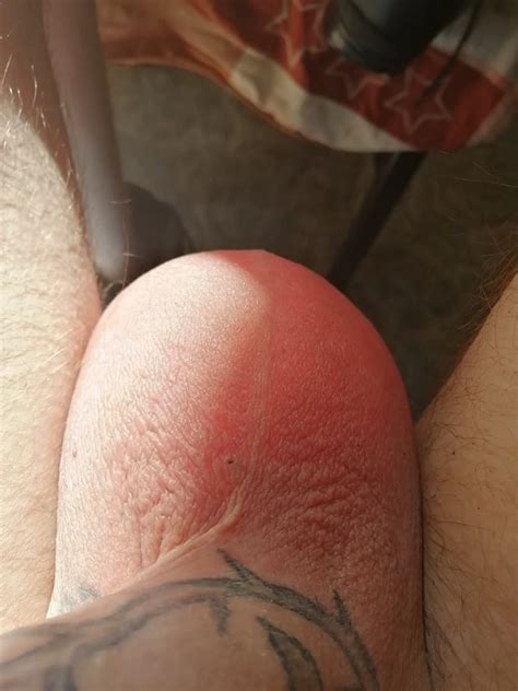 Saline Infusion Scrotum And Titti 3 L 72 Nude Pics 2 Xhamster