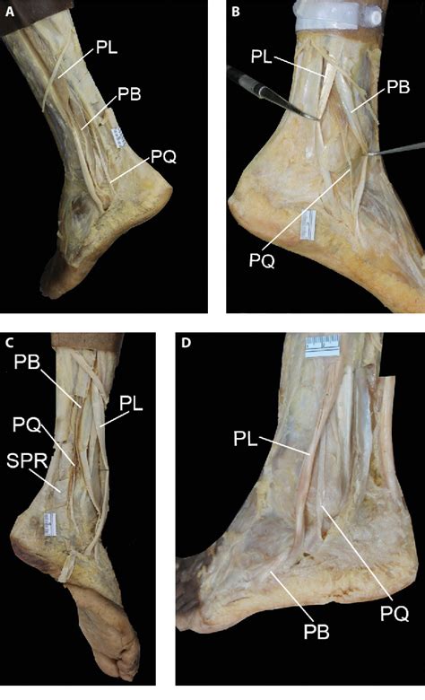 Peroneal Tubercle