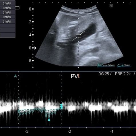 Homogeneous Echotexture Of Liver In Normal Individual Mean Pv Velocity