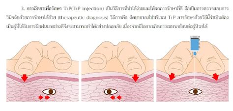 Drrattawach Teach Trigger Point Injection