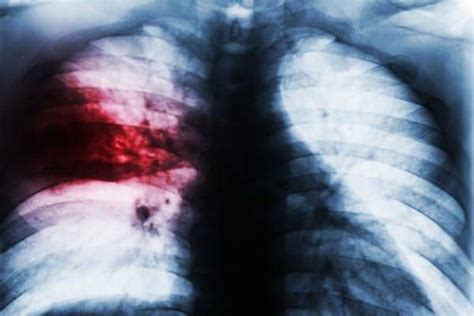 Rsna Announces Pneumonia Detection Machine Learning Challenge Axis
