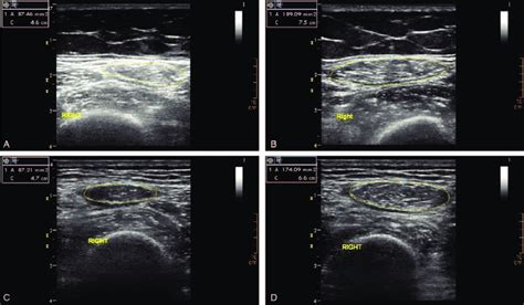 Ultrasound Images Of Rectus Femoris Measured Before And After Download Scientific Diagram