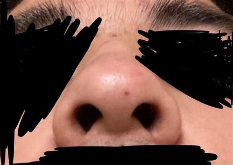 Flat Mole Removal R Plasticsurgery