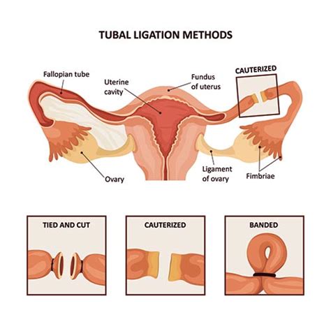 ทําหมันหญิงแล้วท้อง วิธีคุมกําเนิด ทําหมันหญิงมีกี่แบบ
