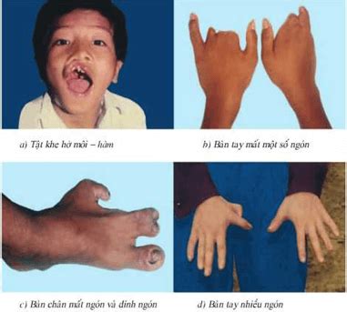 Người bị hội chứng Đao có số lượng NST trong tế bào sinh dưỡng bằng