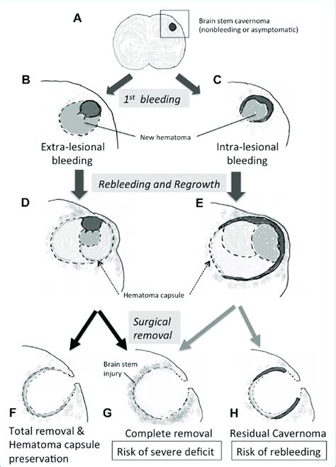 A Schematic Drawing Of The Cavernoma Structure B And C The Download Scientific Diagram