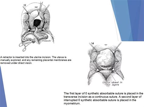 Abdominal Incision And Abdominal Anatomy Ppt