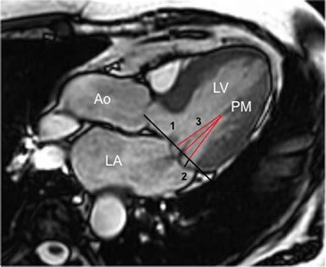 Bileaflet Mitral Valve Prolapse On Cine Cmr Images 1 Mitral Annulus Download Scientific