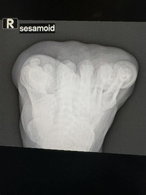 Sesamoid View Rradiology