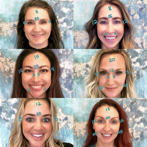 Botox Dosing Why Its Important To Properly Dose Beyondaesthetics