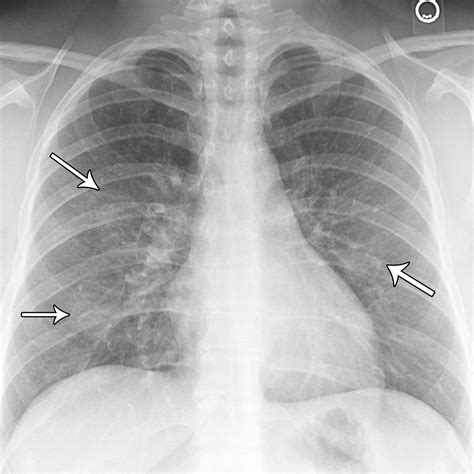 Chest X Ray Chronic Bronchitis At Bennie Morris Blog