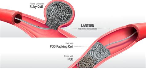 Embolisation System Vascupedia
