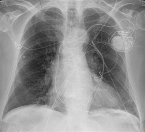 Biventricular Pacemaker Malposition