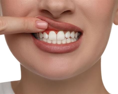 Gingivitis The Early Stage Of Periodontal Disease The More Clinics