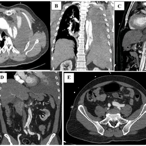 Stanford Type B Aortic Dissection And Type Iii Aortic Dissection
