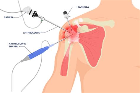 Frozen Shoulder Rockwall Tx Manoj Reddy
