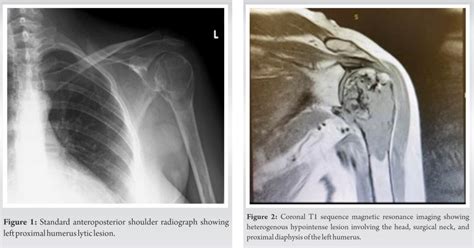 Chondrosarcoma In Proximal Humerus The First Reported Case In Lebanon