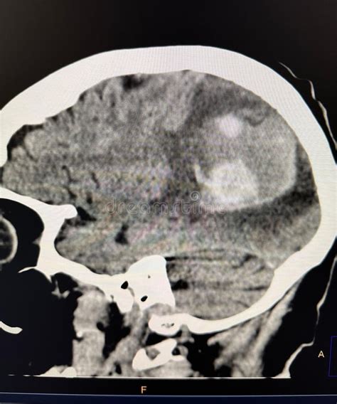 CT Scan Of The Brain With Abnormality Stock Photo Image Of Gray Abnormality 367423712