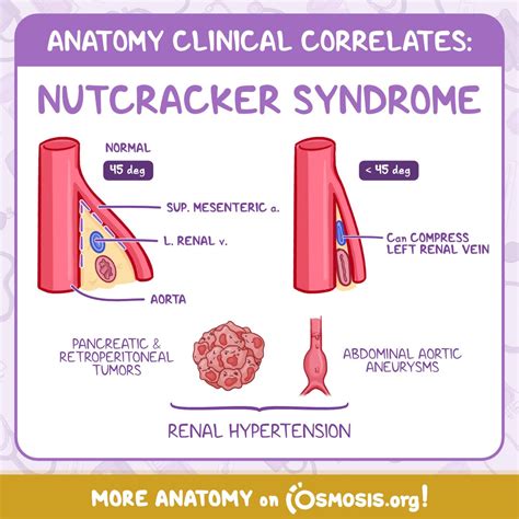 Nutcracker Syndrome Guidelines At Ethel Laskey Blog