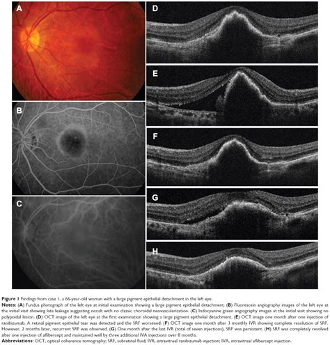 Effect Of Intravitreal Aflibercept Injection For Age Related Macular D Opth