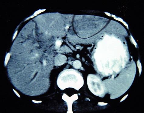 Sclerosing Cholangitis Surgery Photos