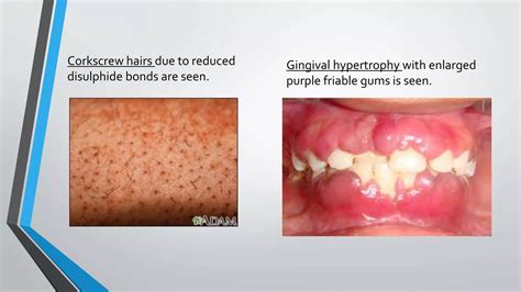 Cutaneous Manifestations Of Vitamin C Deficiency Ppt