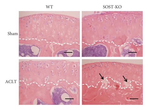 after aclt sost ko mice presented with a severer oa phenotype when