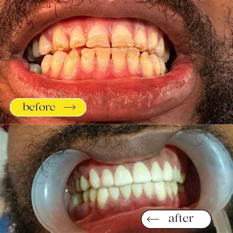 Fix Stained Chipped Or Misaligned Teeth With Veneers Today Health Nigeria