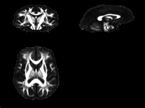 Figure 1 From High Dimensional Spatial Normalization Of Diffusion Tensor Images Improves The