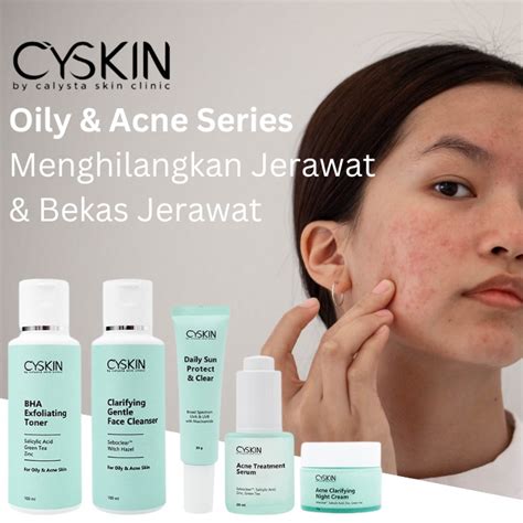 Jual Paket Acne Calysta Serum Atasi Jerawat Merah Calysta Skin Clinic Shopee Indonesia