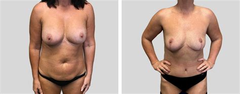Tummy Tuck Explant And Breast Lift Hernia Repair Breast And Body Clinic