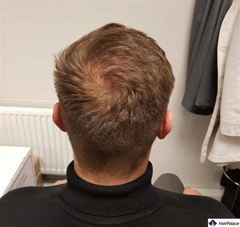 Crown Hair Transplant Is It A Good Idea
