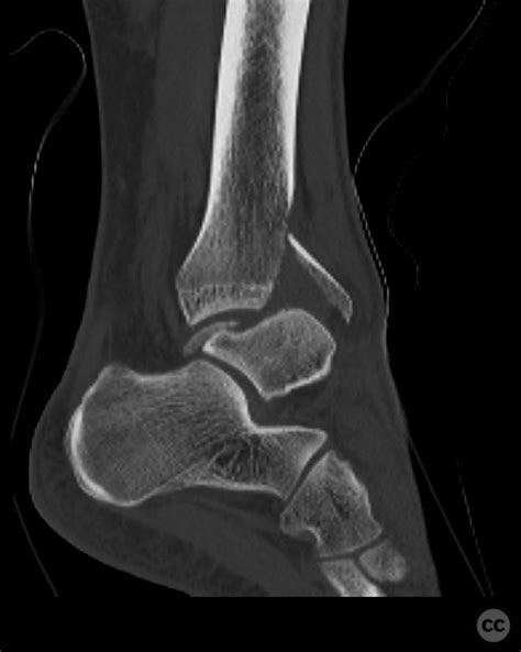 Anterior Fracture Dislocation With Impression Fracture Of The Articular Talar Dome