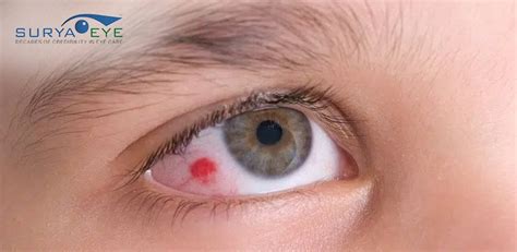 Bloodshot Eyes After Lasik Surgery Causes And Treatment Options