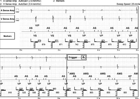Inappropriate Mode Switching In A Dual Chamber Defibrillator System
