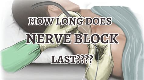 How Long Does A Nerve Block Last TIPSS