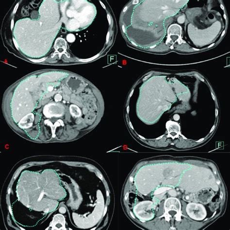 Flowchart And Components Of The Liver Segmentation System