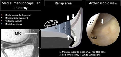Knee Mri Meniscus Roots Ramps Repairs And Repercussions Radiographics