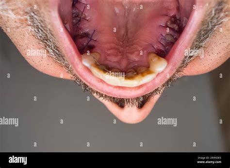 Detail Of The Upper Male Palate With The Gum Stitched After The
