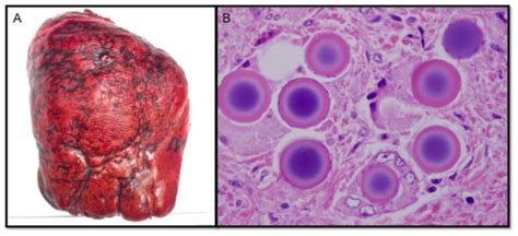 Hepatectomy After Yttrium 90 Y90 Radioembolization Induced Liver Fibrosis Pmc